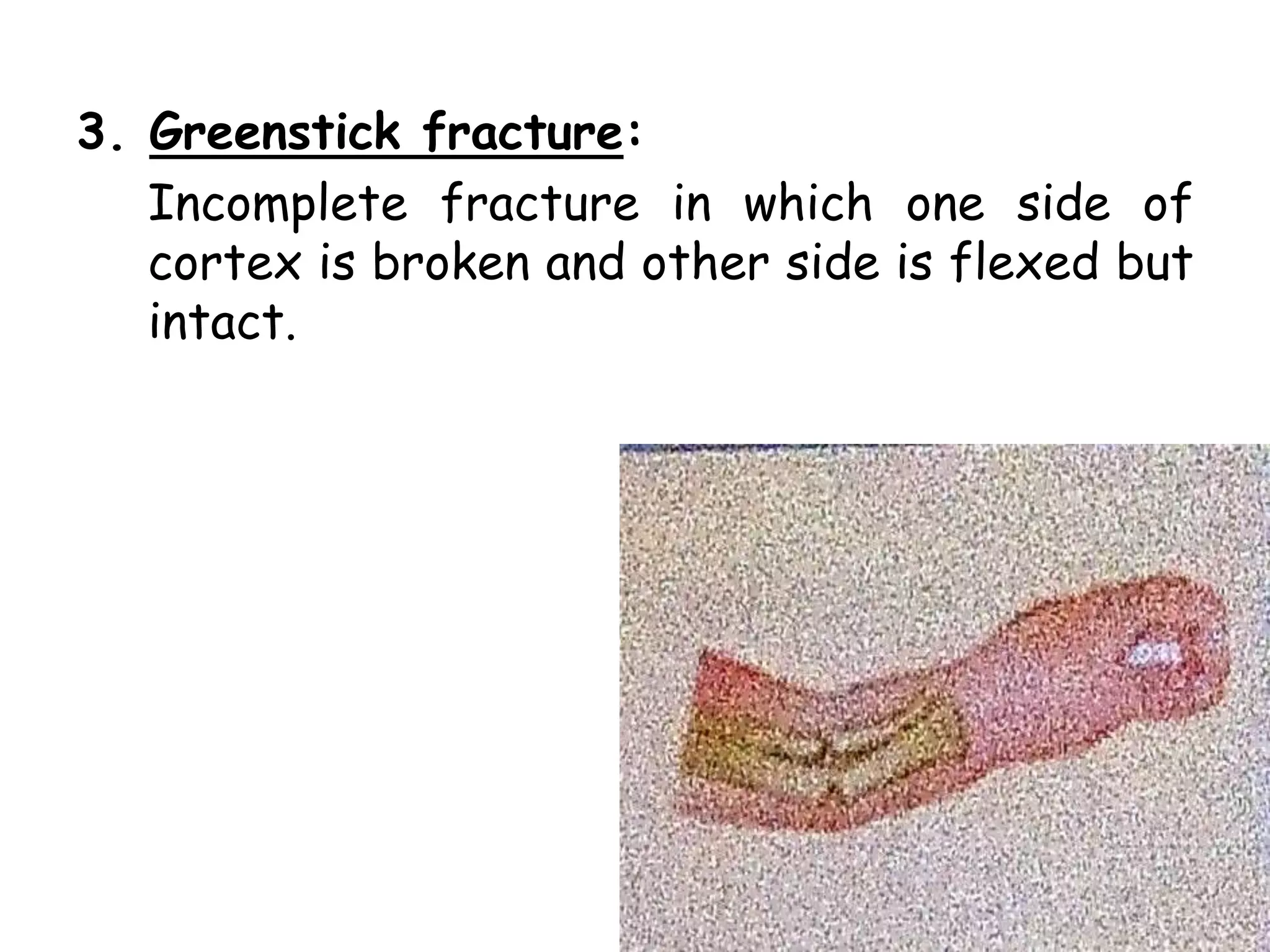 Fractures | PPTX