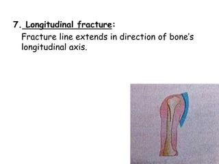 Fractures | PPTX
