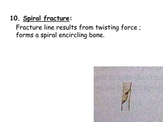Fractures | PPTX