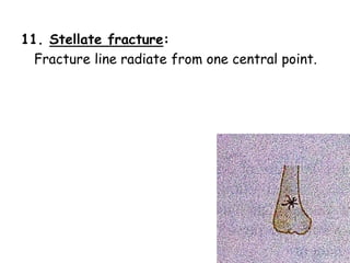 Fractures | PPTX