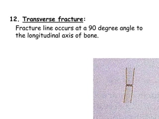 Fractures | PPTX