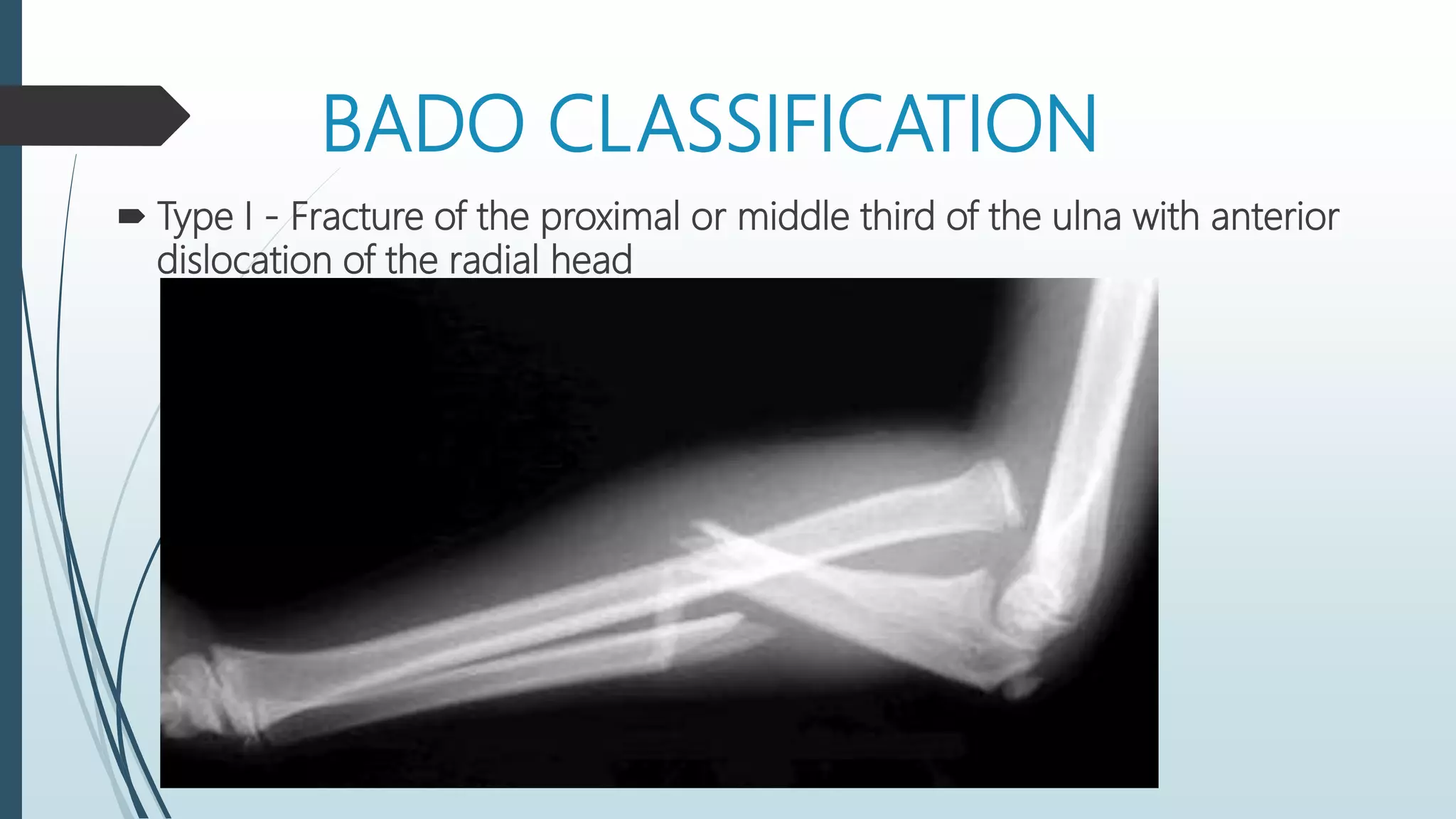 Fractures of radius and ulna . | PPTX