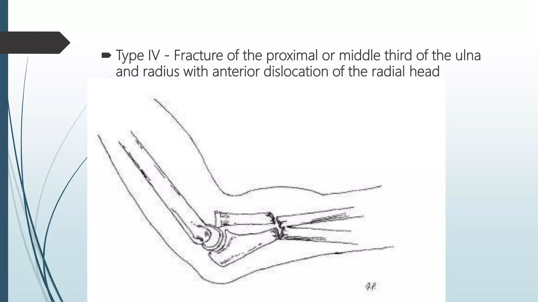 Fractures of radius and ulna . | PPTX