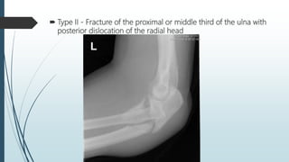 Fractures of radius and ulna . | PPTX