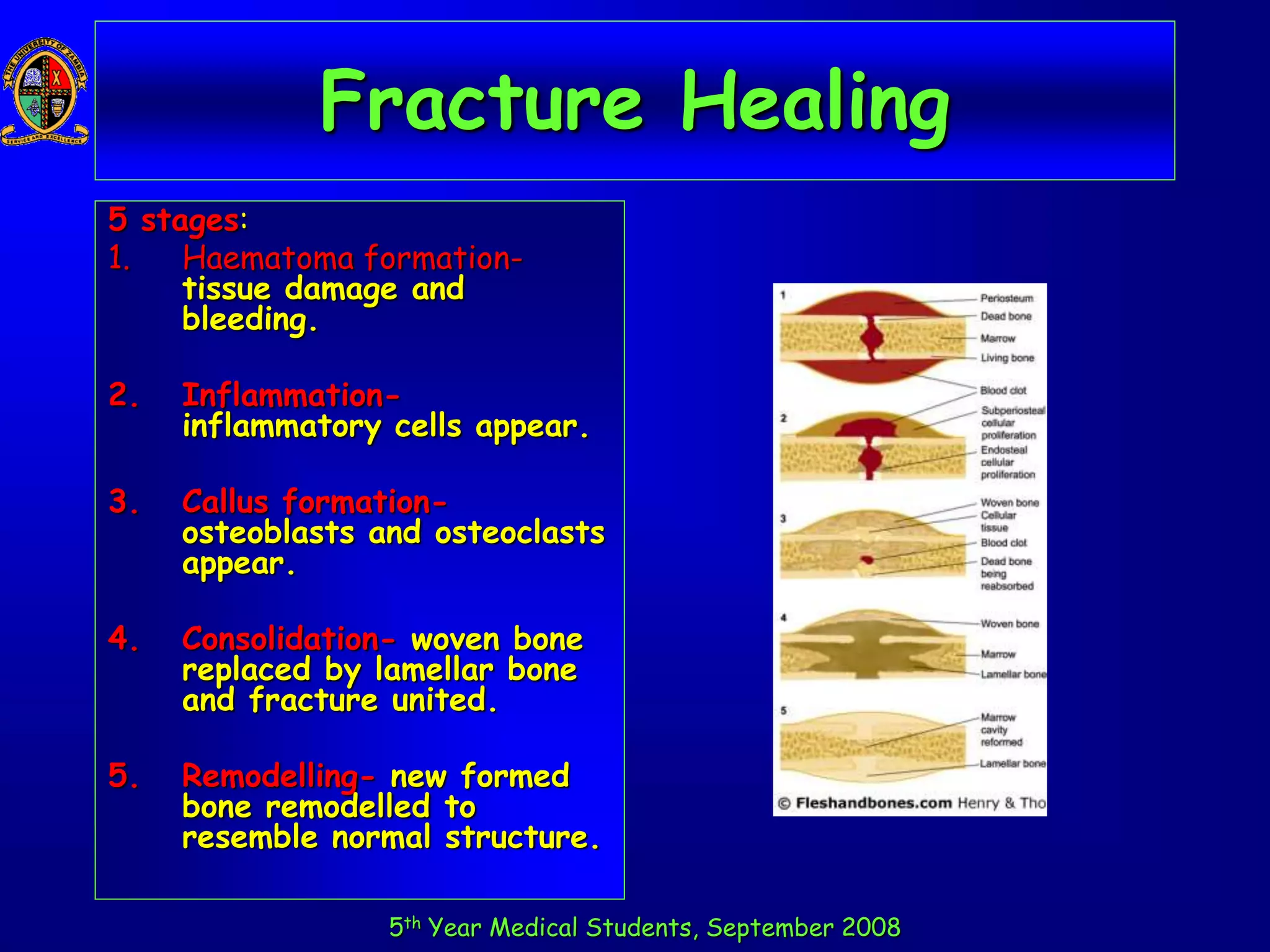 Fractures.ppt