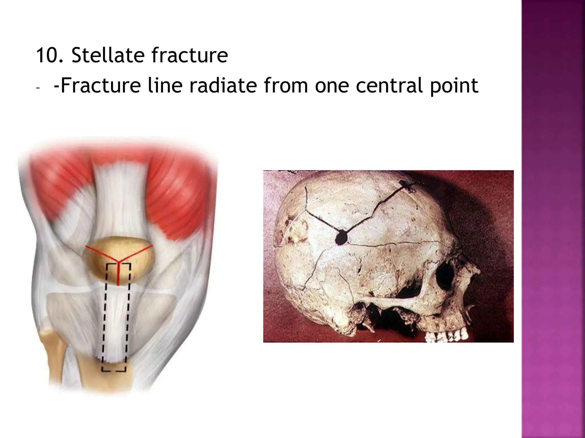 FRACTURES NOTES PREPAIRED BY NATUNGA RONALD | PPTX