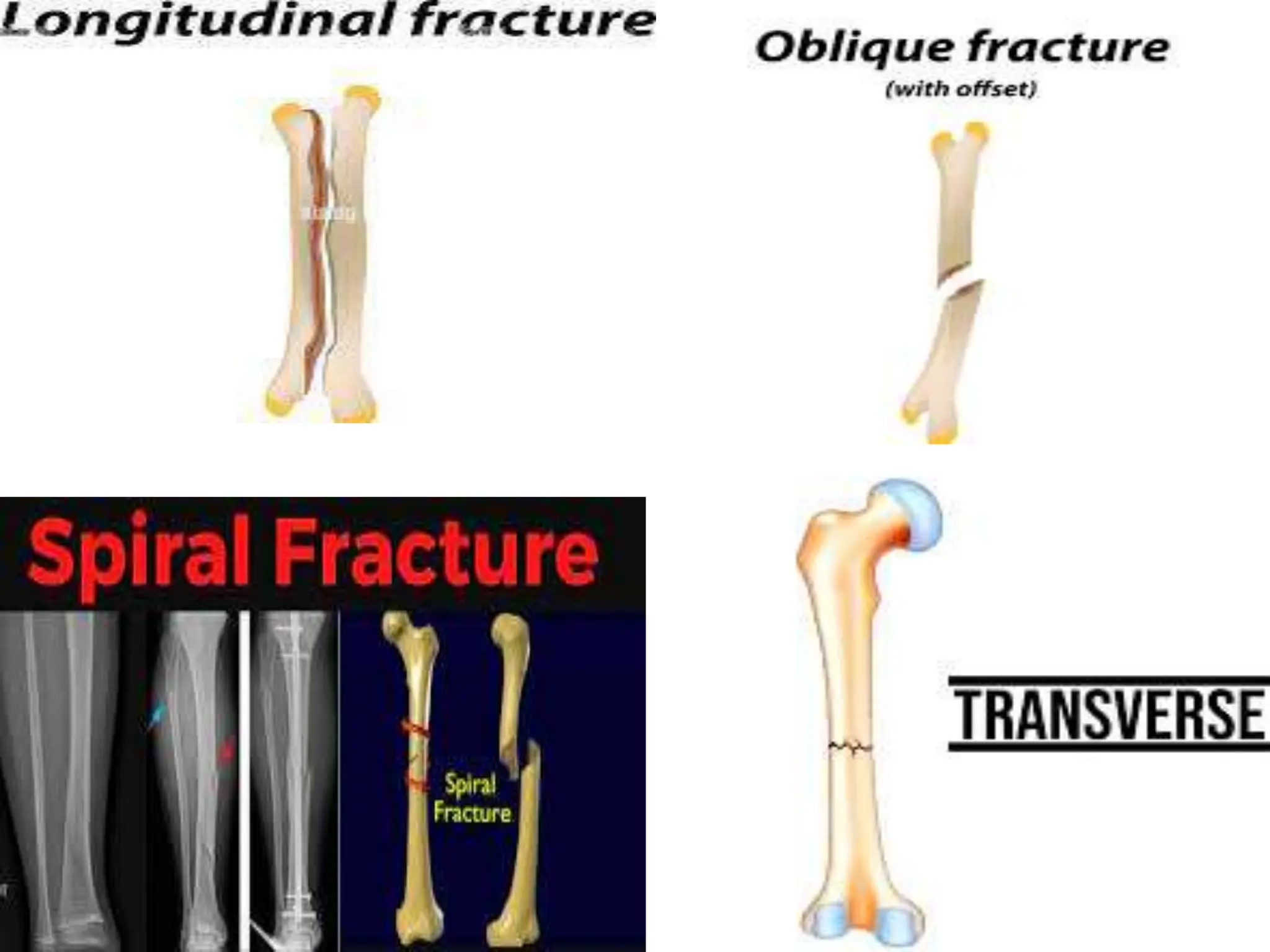 power point presentation fractures note | PPTX