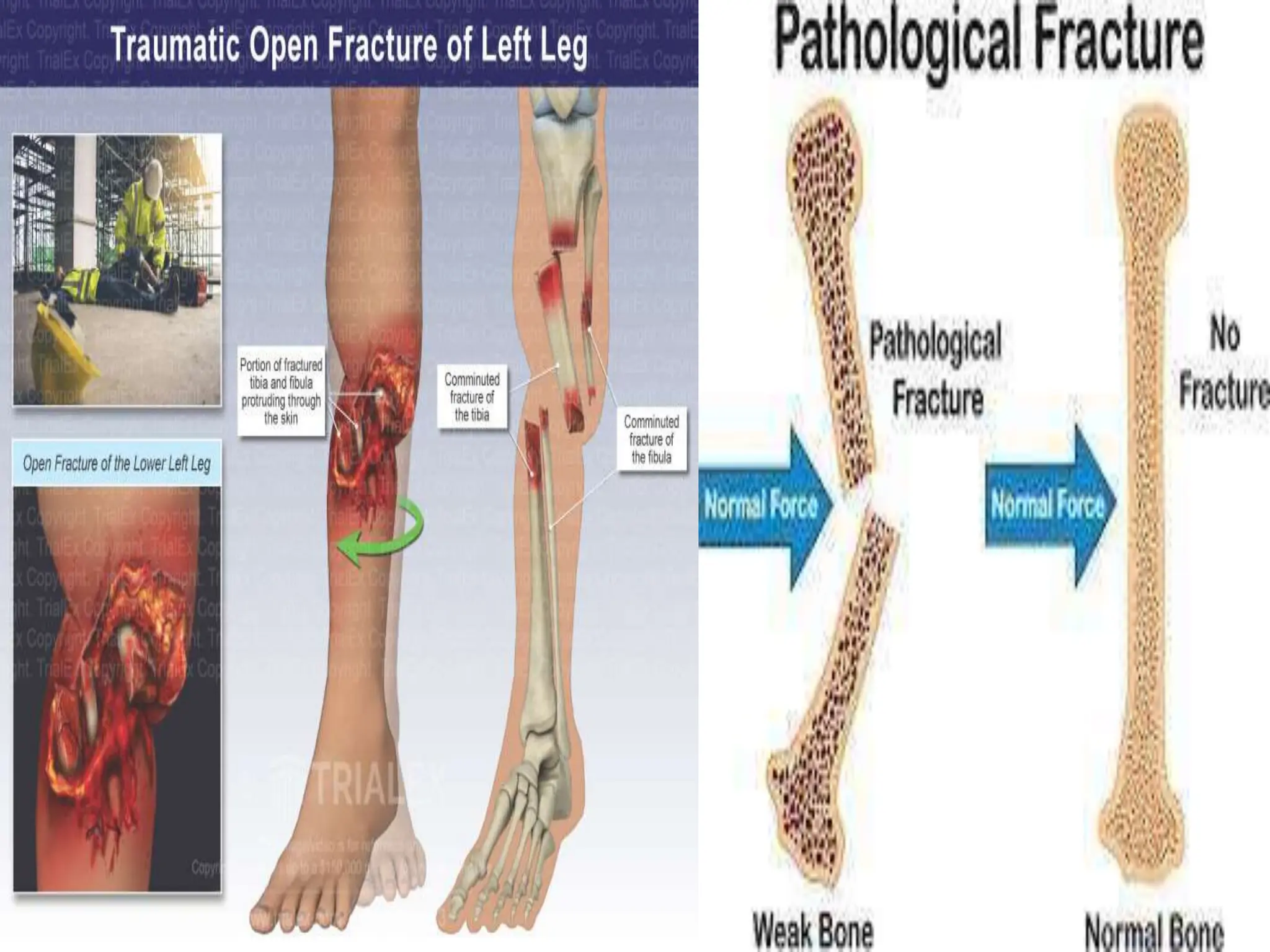 power point presentation fractures note | PPTX