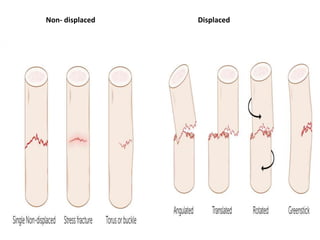power point presentation fractures note | PPTX