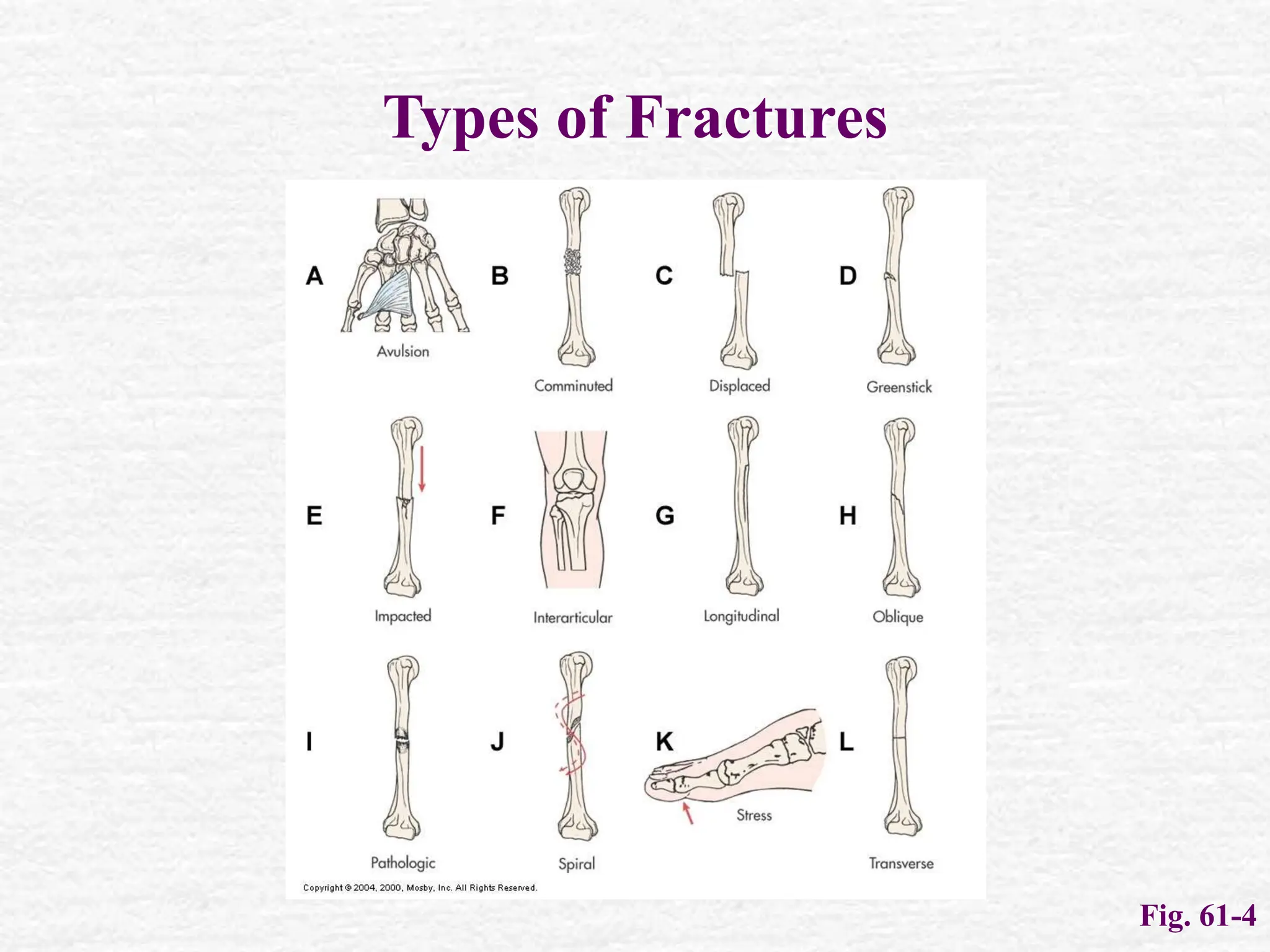 Fractures medical surgical nursing .ppt