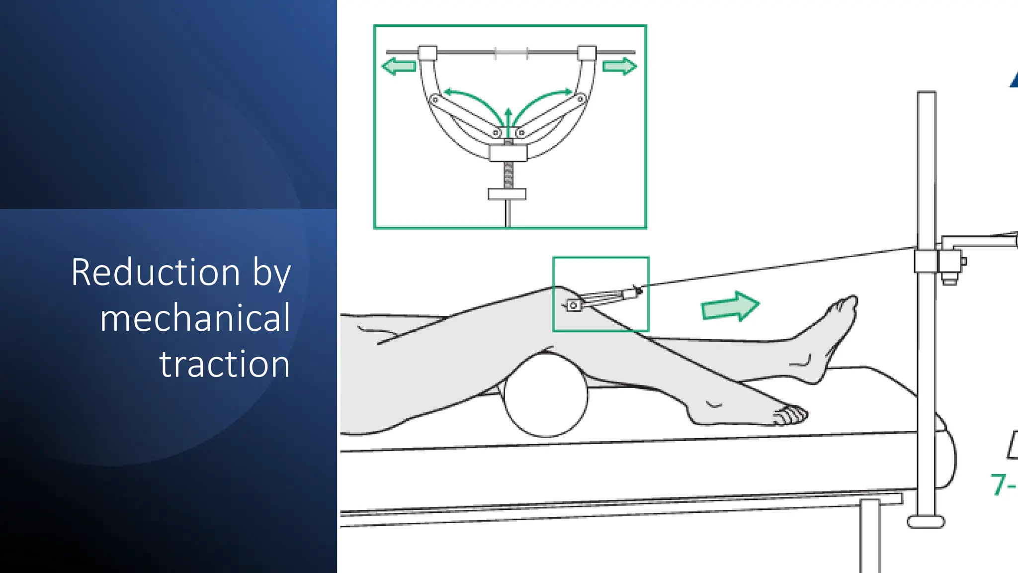 Orthopaedic and surgical conditions - Fractures.pptx