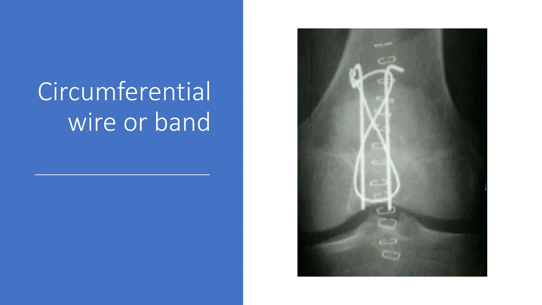 Orthopaedic and surgical conditions - Fractures.pptx