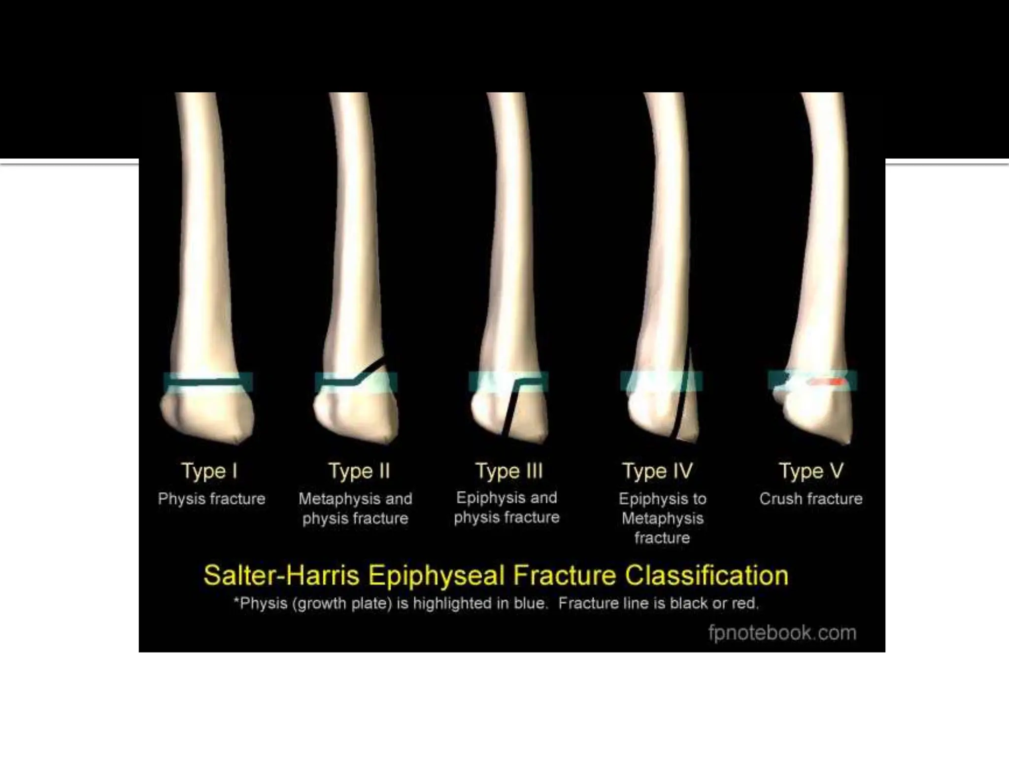 Classification and types of fractures, principles of trauma surgery.pptx