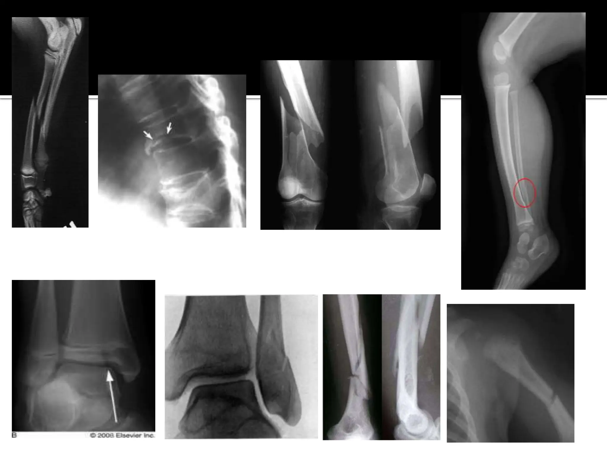 Classification and types of fractures, principles of trauma surgery.pptx