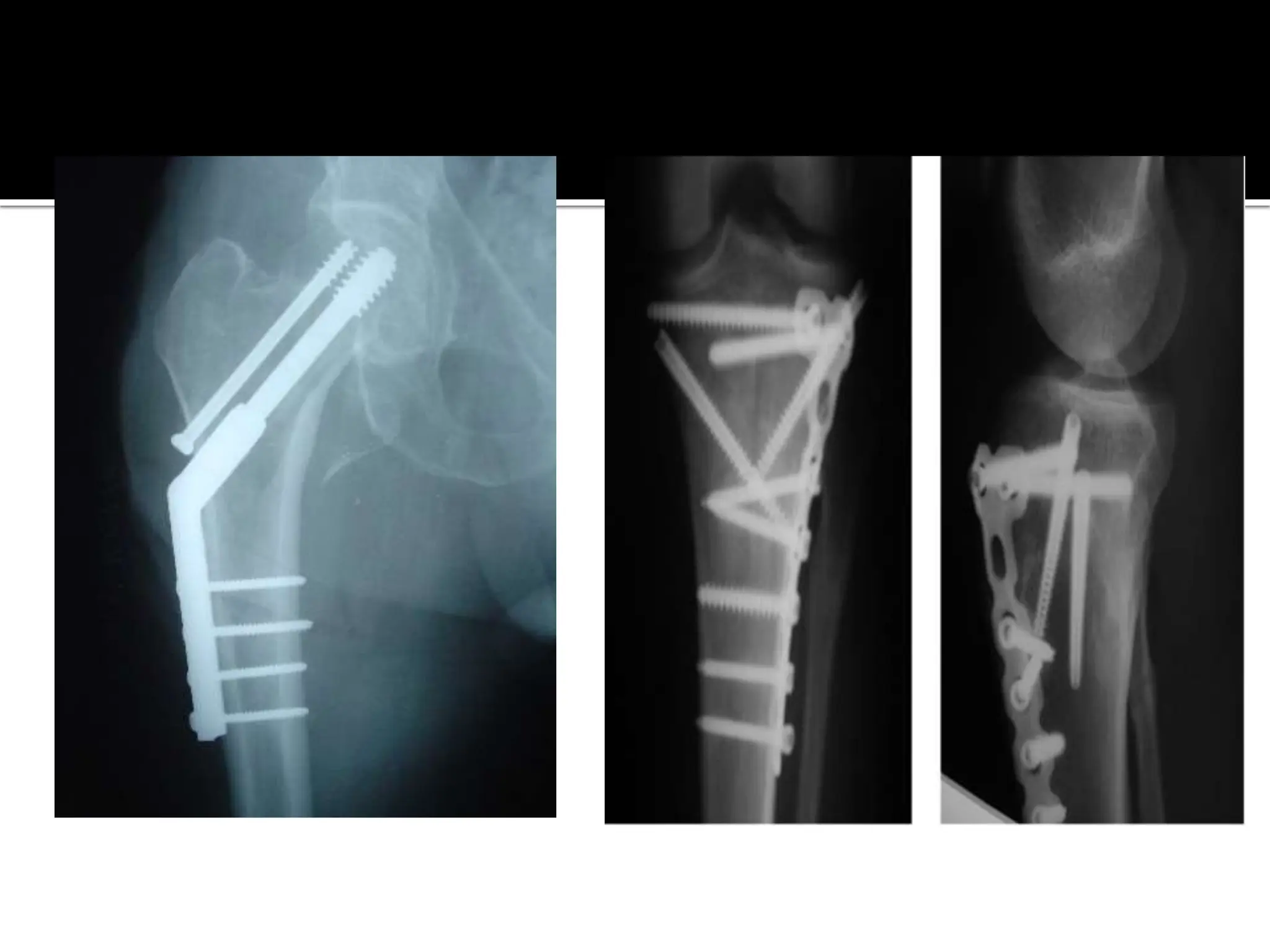 Classification and types of fractures, principles of trauma surgery.pptx