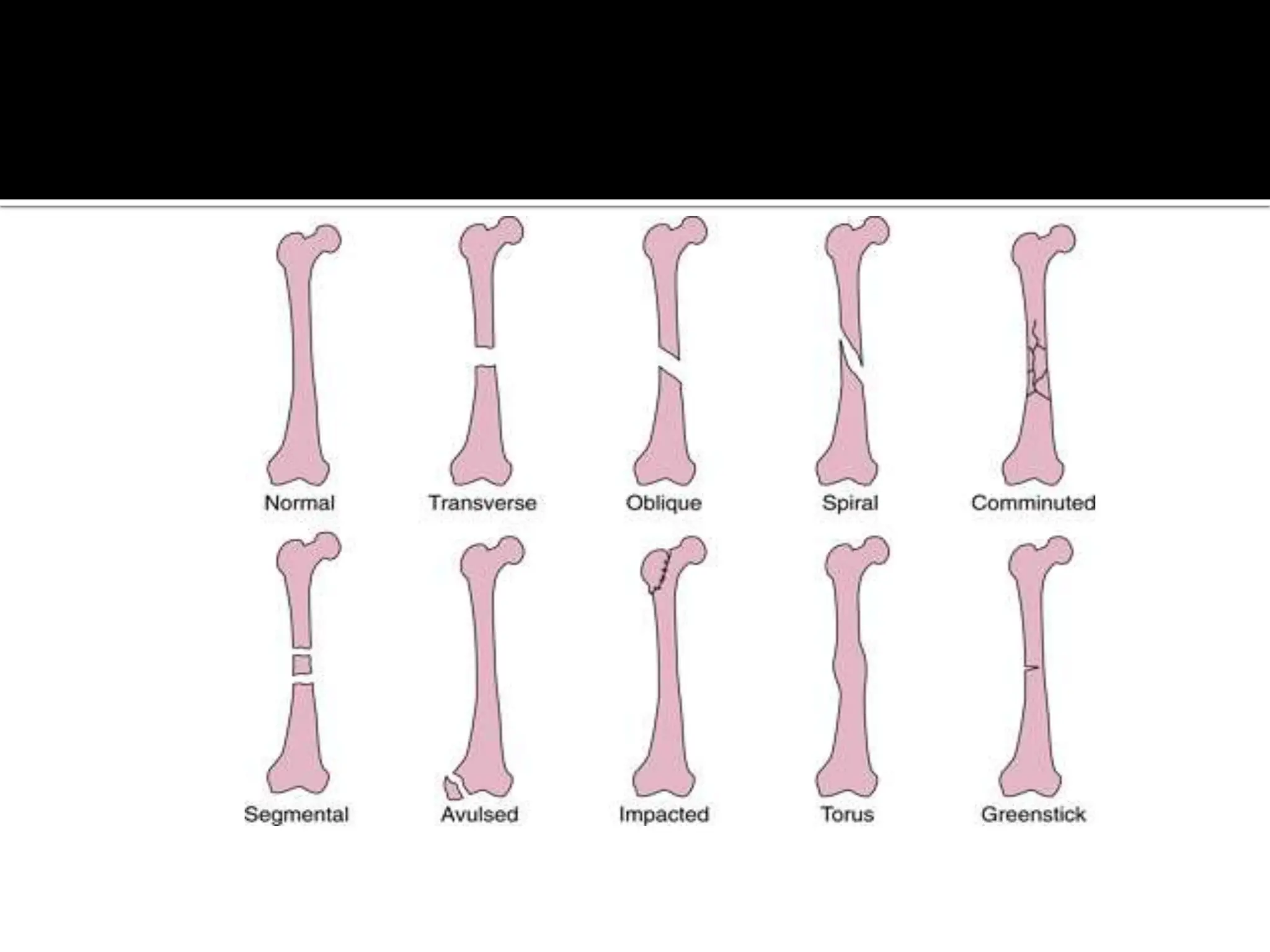 Classification and types of fractures, principles of trauma surgery.pptx
