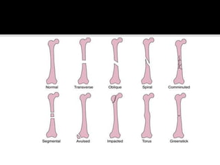 Classification and types of fractures, principles of trauma surgery.pptx