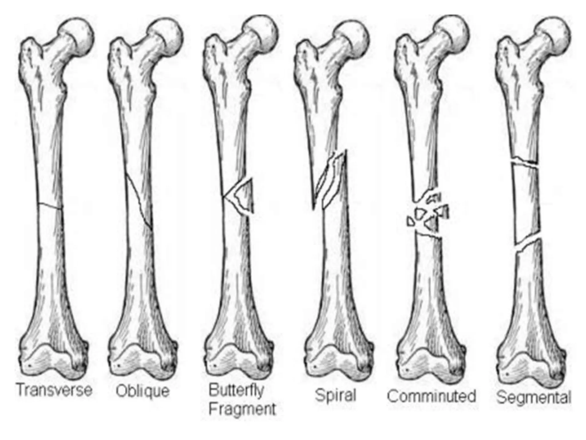 Fractures forms and types in skeletal system pptx | PPTX