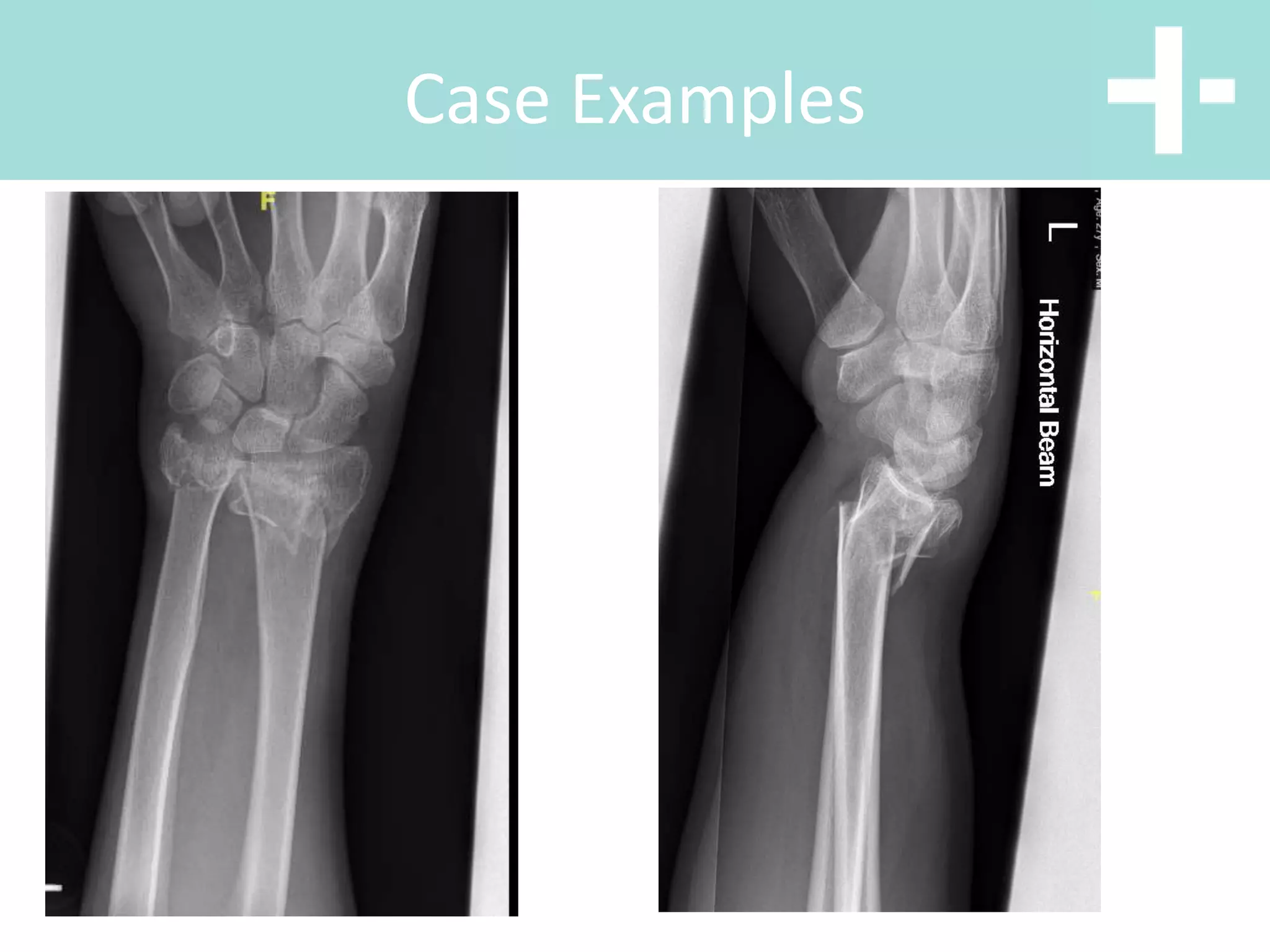 Distal Radius and Wrist Fractures | PPTX