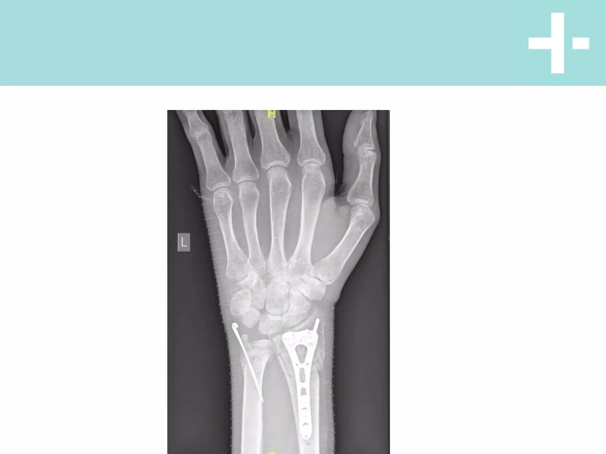Distal Radius and Wrist Fractures | PPTX
