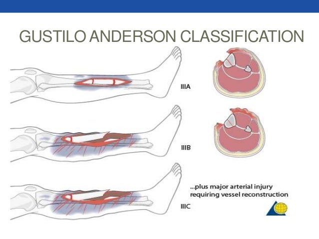 Fractures By Dr Jamal Alvi