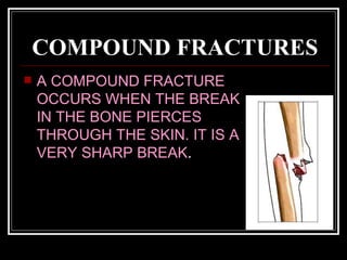 Fractures.ppt by bernita | PPT