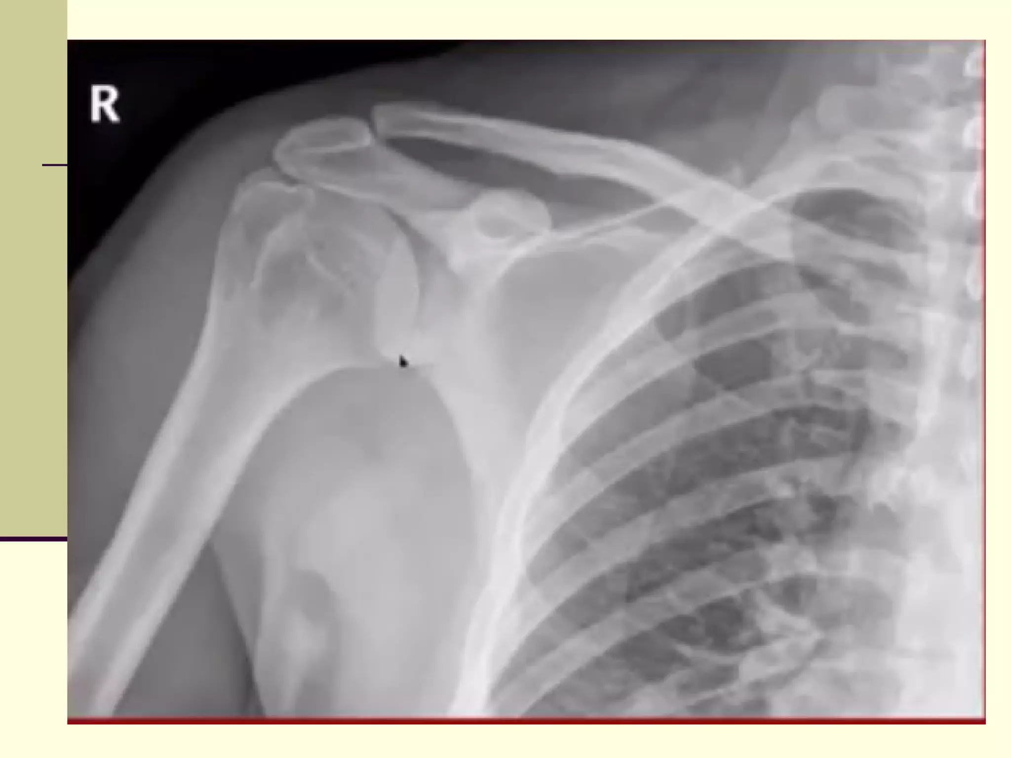 Fractures and Dislocations- Upper-limb | PPT
