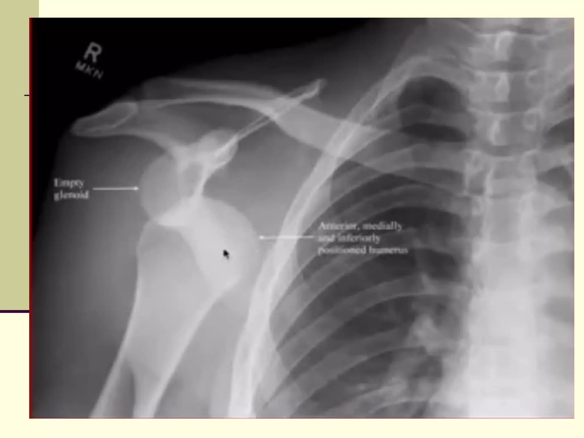 Fractures and Dislocations- Upper-limb | PPT