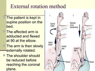 Fractures and Dislocations- Upper-limb | PPT