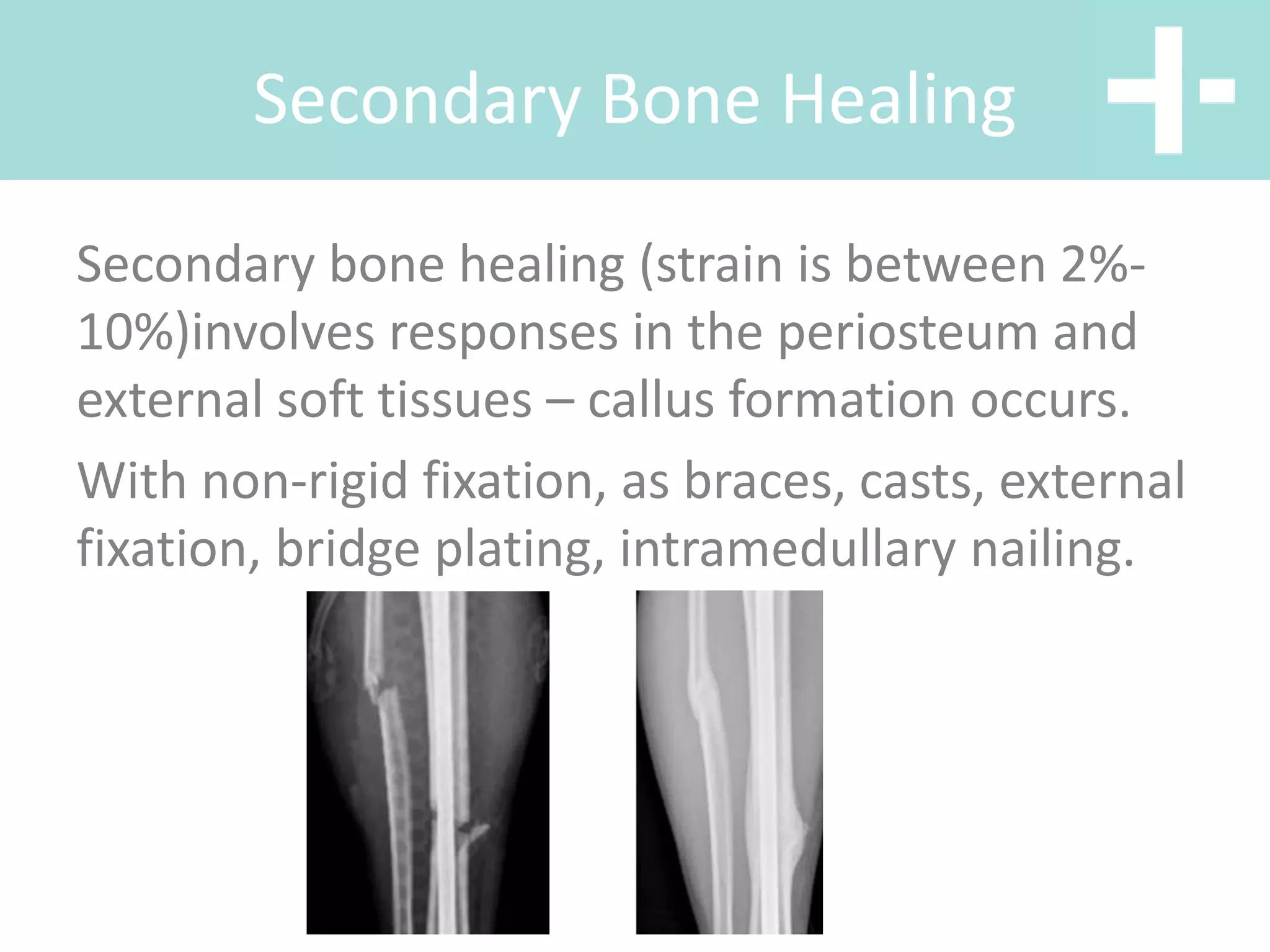 Fractures why fix it like that | PPTX