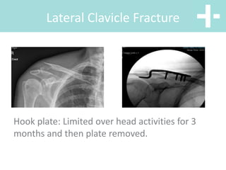 Fractures why fix it like that | PPTX