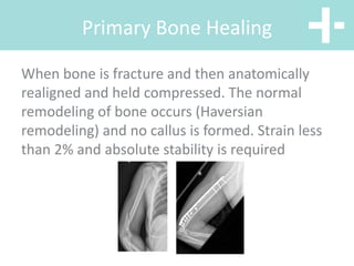 Fractures why fix it like that | PPTX