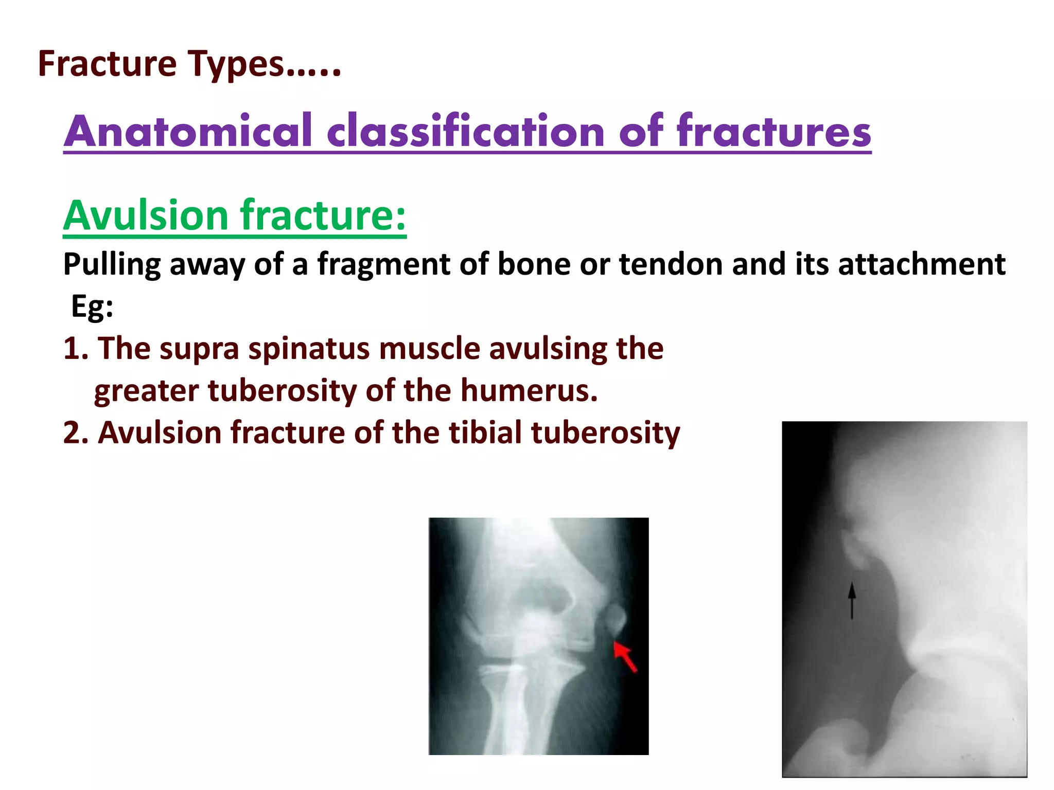 Fractures - general view | PPTX