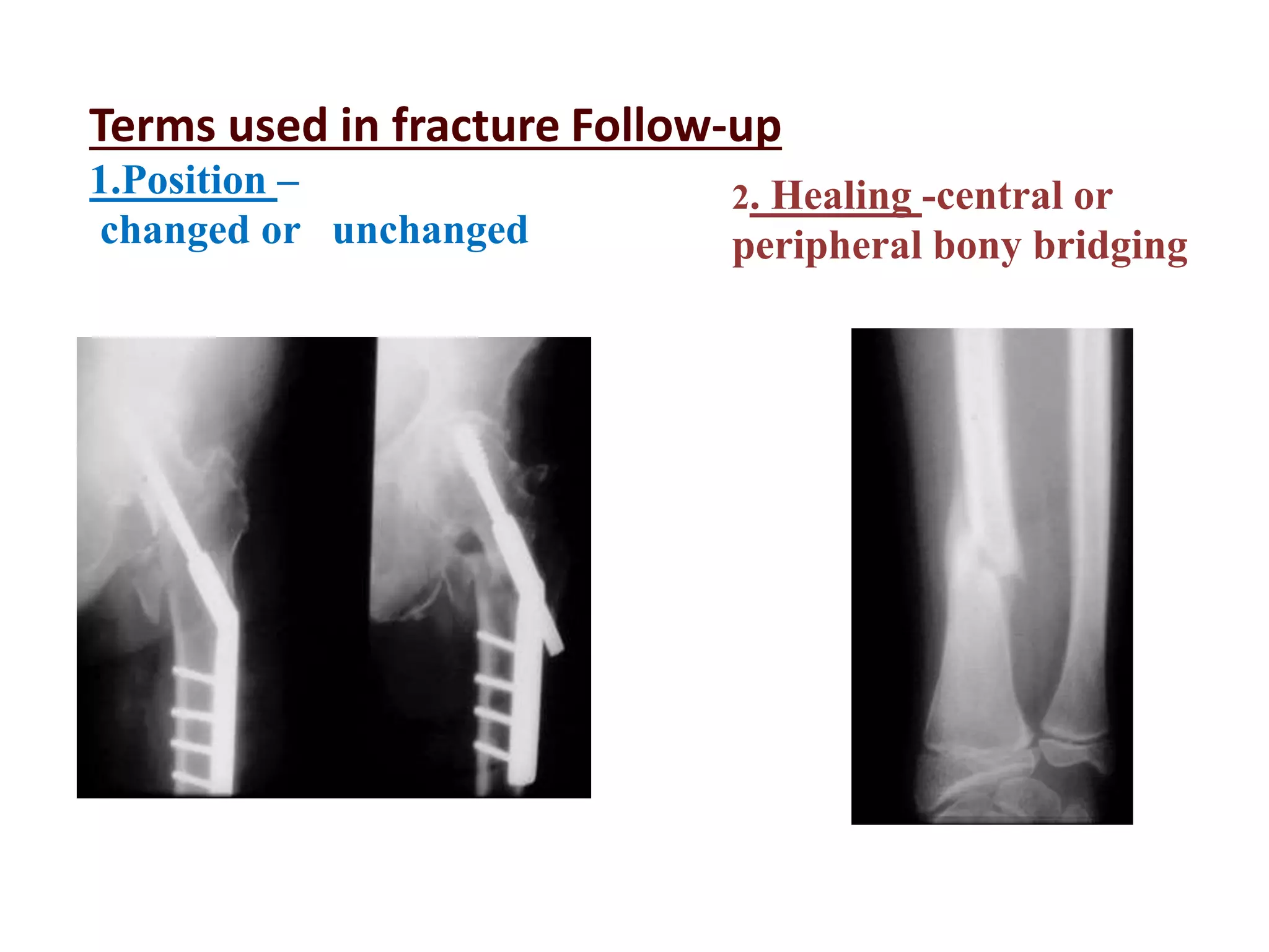 Fractures - general view | PPTX