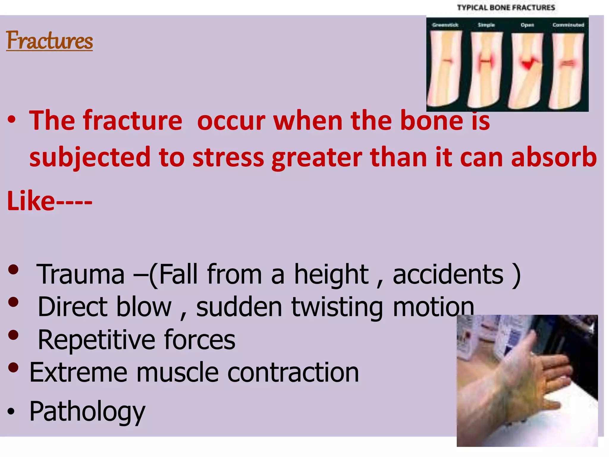 Fractures - general view | PPTX