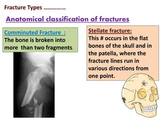 Fractures - general view | PPTX