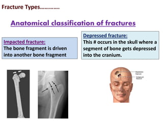Fractures - general view | PPTX