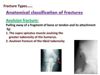 Fractures - general view | PPTX