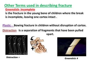 Fractures - general view | PPTX