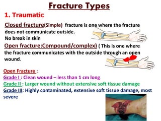 Fractures - general view | PPTX