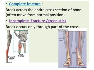 Fractures - general view | PPTX