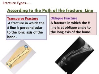 Fractures - general view | PPTX
