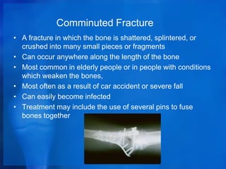 Fractures Chapter 4 | PPT