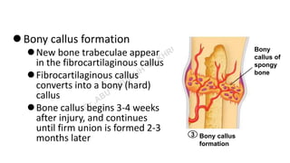Fractures and Bone healing | PPT