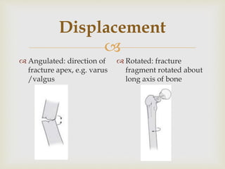 Fractures and dislocations | PPTX