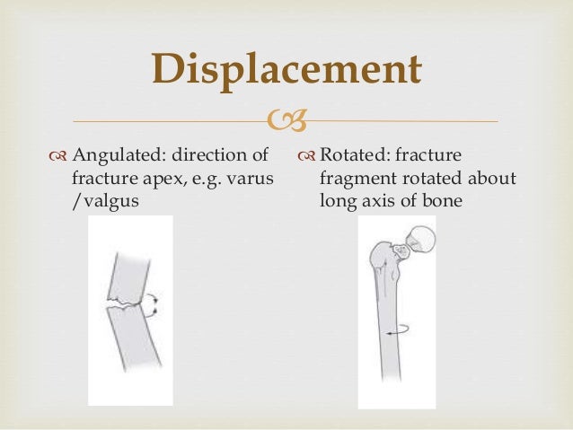 Varus Vs Valgus Fracture