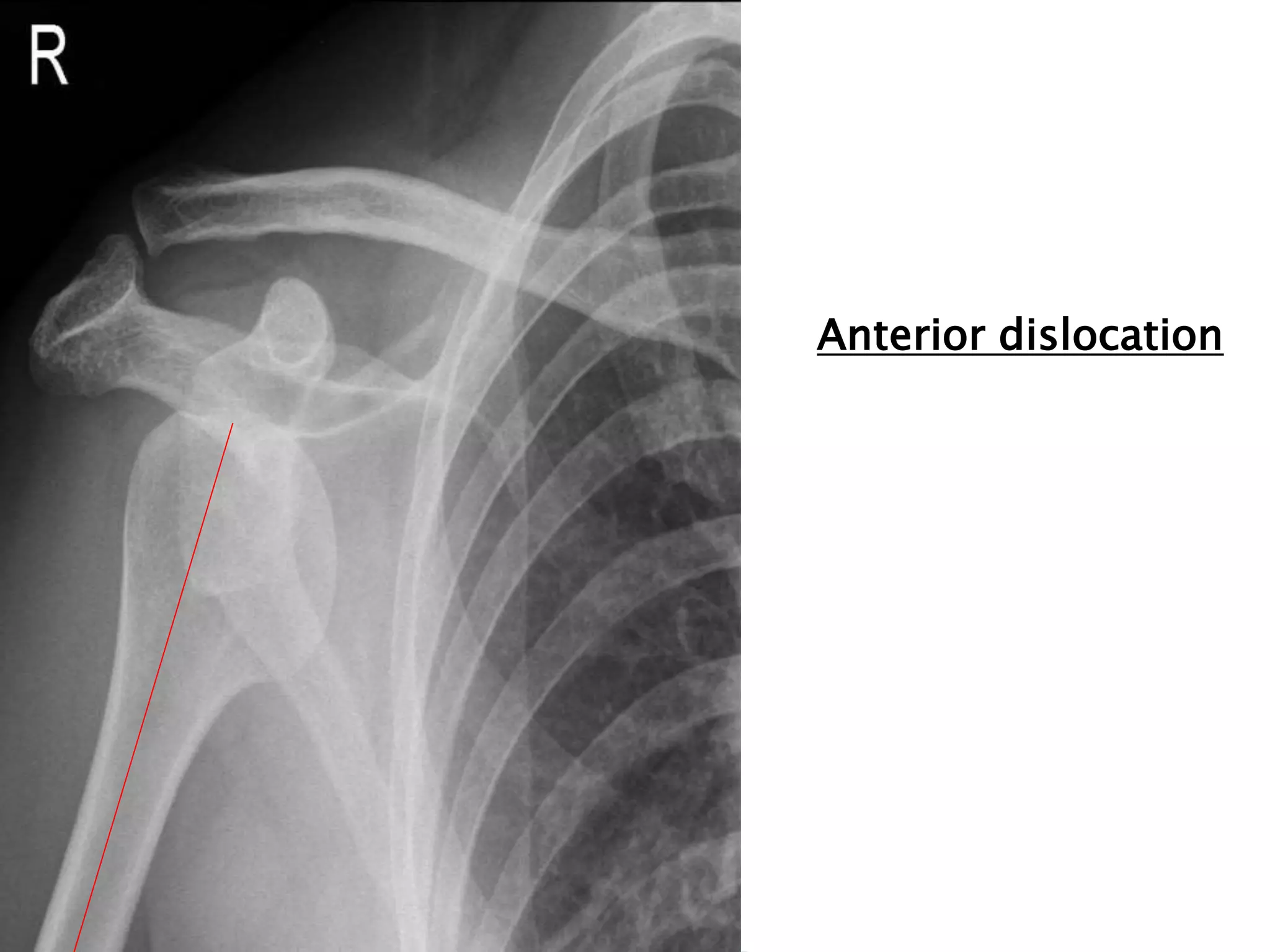 upper limb Fractures and dislocations | PPTX