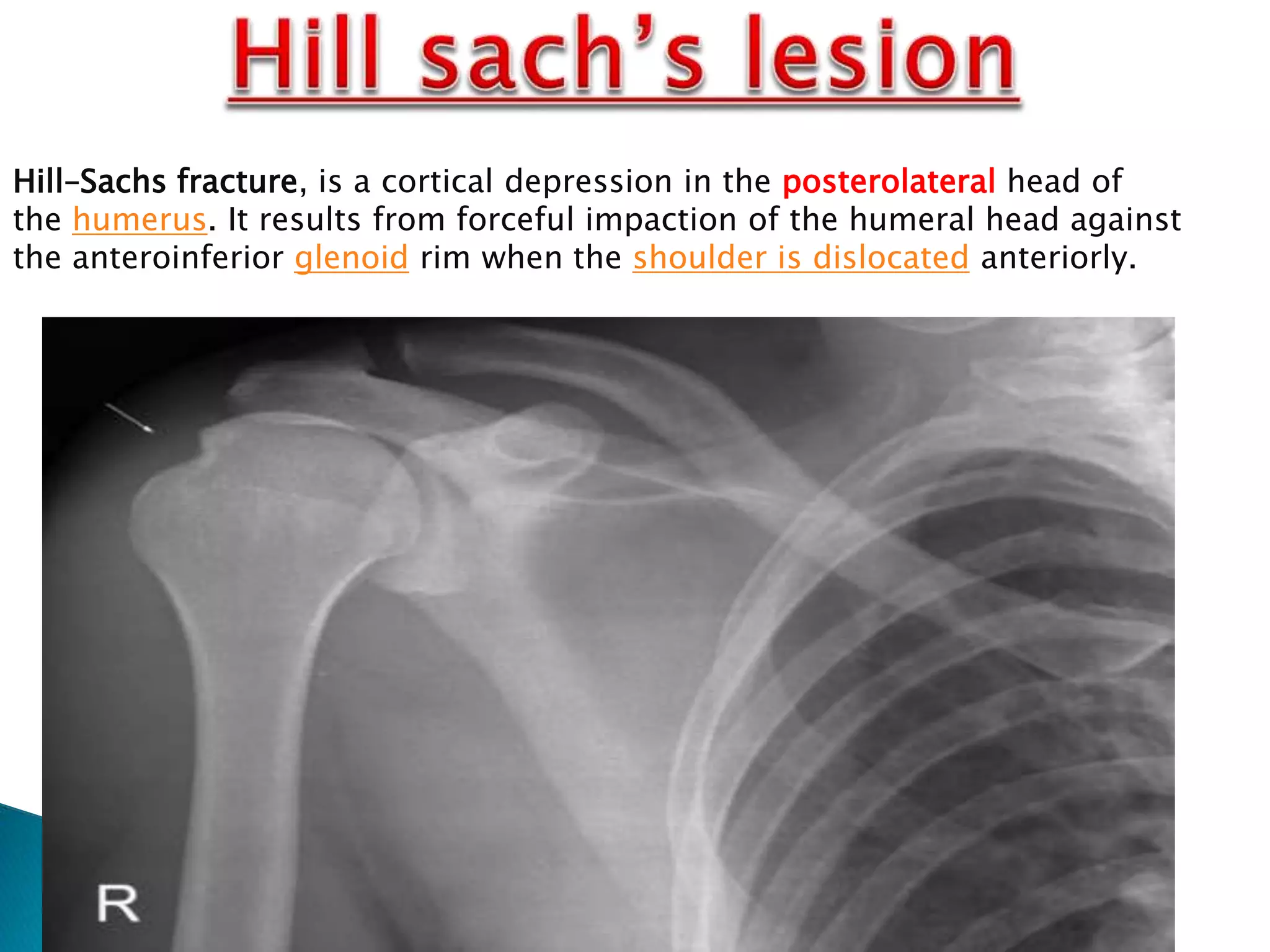 upper limb Fractures and dislocations | PPTX