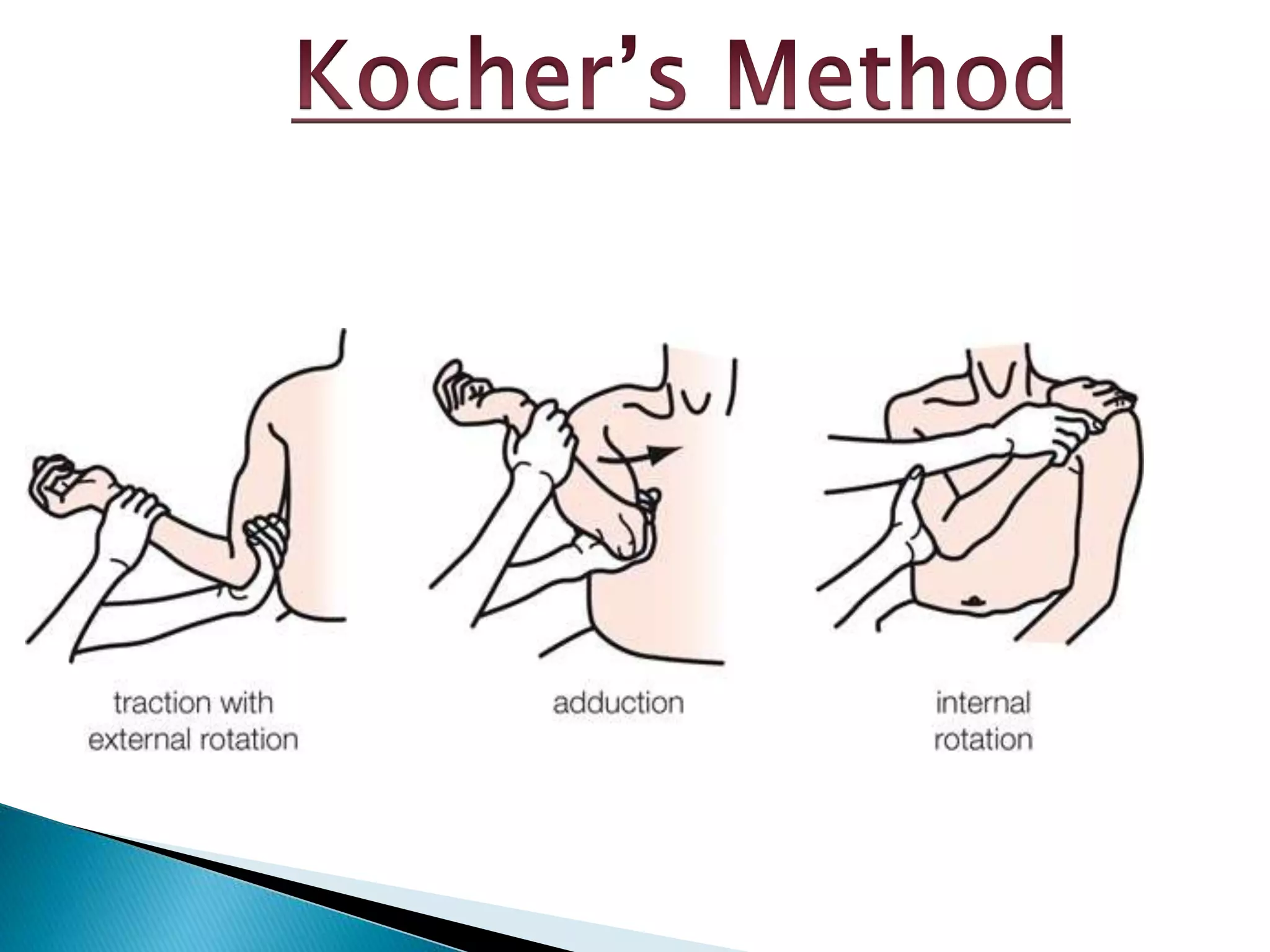 upper limb Fractures and dislocations | PPTX