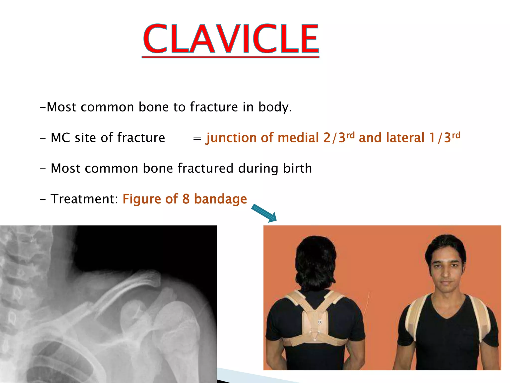 upper limb Fractures and dislocations | PPTX
